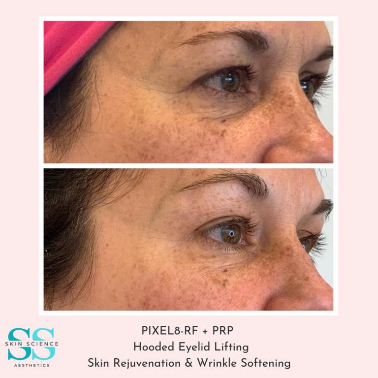 THE PIXEL8-RF – Skin Science Aesthetics | Tallahassee Skin Care